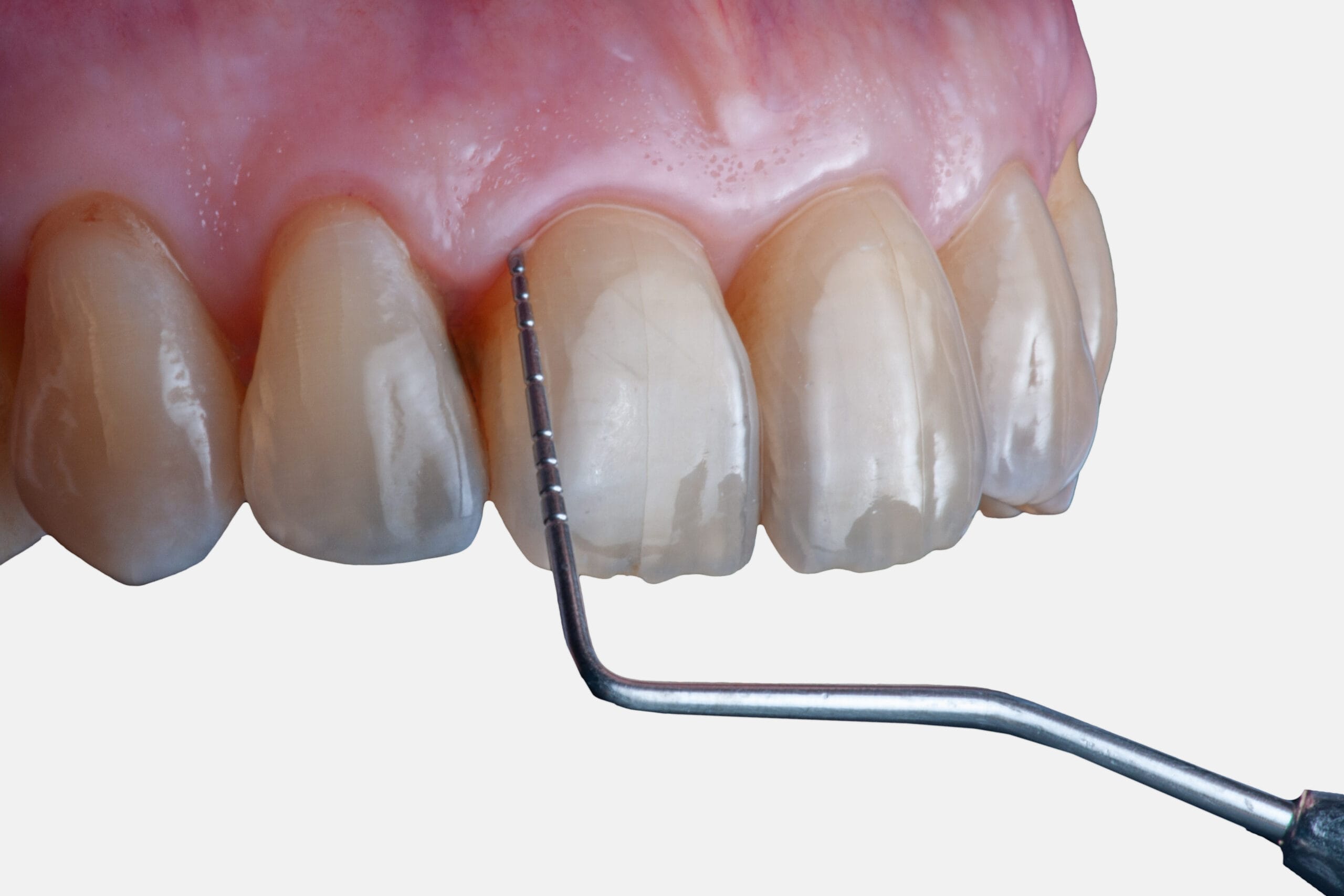 Parodontite - IMI EDN